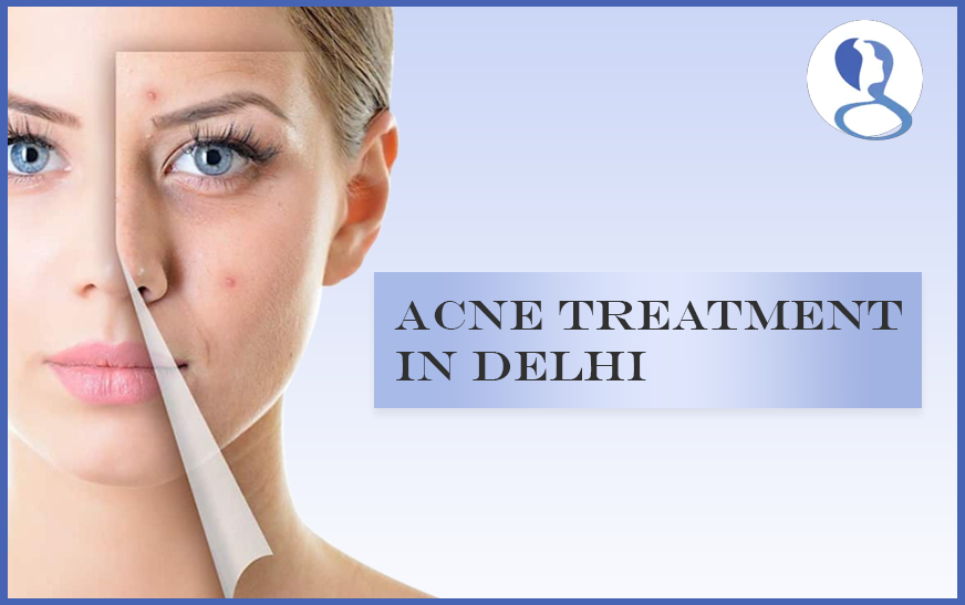 How Can One Manage Stress-Related Acne? - Lets Jump Today